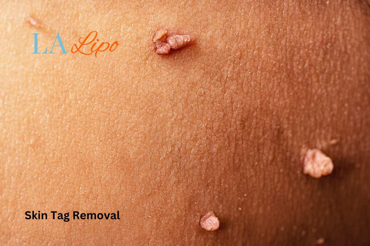 What Does Skin Look After Skin Tag Removal Macclesfield